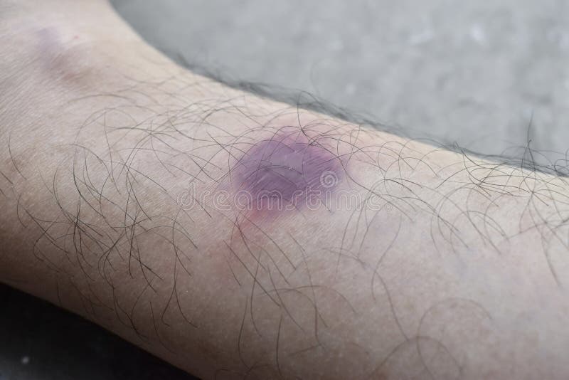 Mosquito Bite Cellulitis Stock Photos - Free & Royalty-Free Stock ...