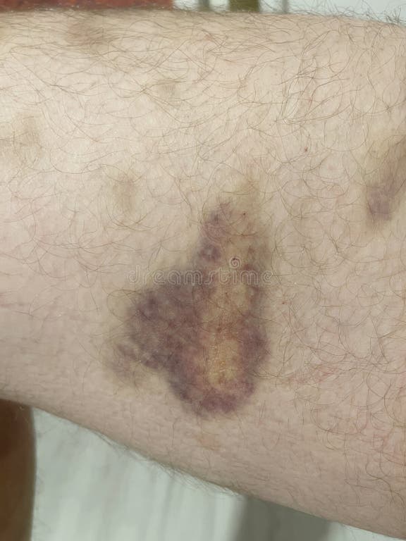 Bruise on the Leg. Hematoma. Purple Bruise Stock Image - Image of ...