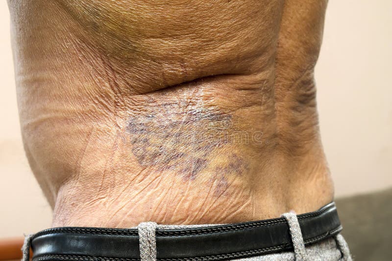 The Bruise on the Man& X27;s Back,coccyx after Falling Down. Man ...