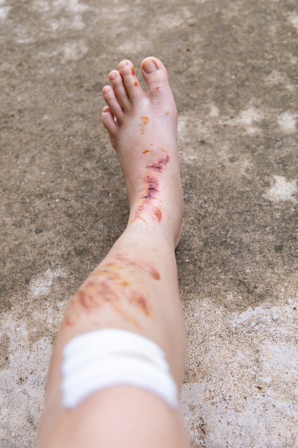 278 Foot Bleeding Photos - Free & Royalty-Free Stock Photos from Dreamstime