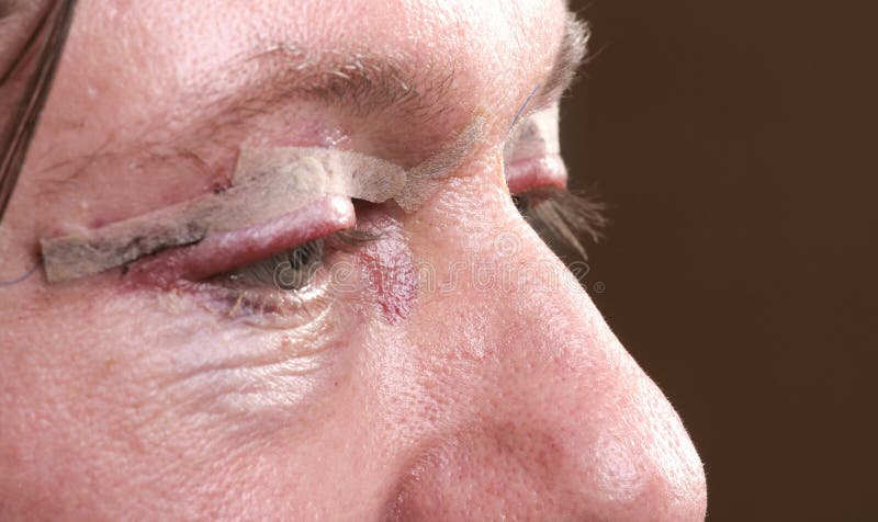 Bruised eye after surgery stock image. Image of lift - 18850477