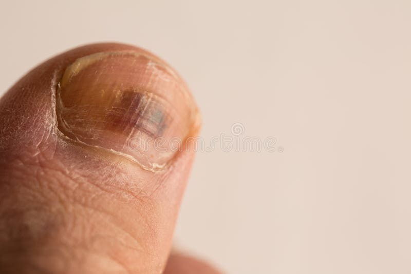 Finger with Bruised Nail (Subungual Hematoma) Stock Image - Image of ...