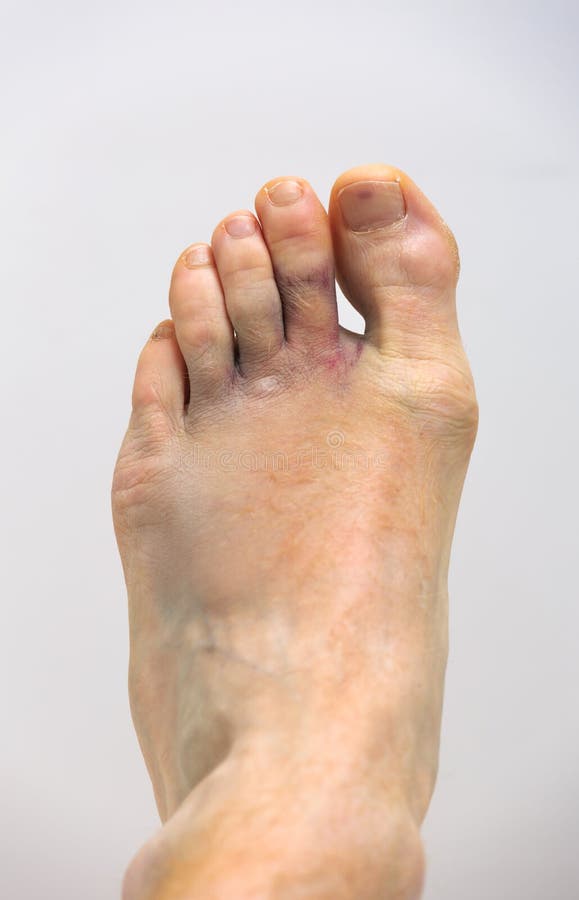 Bruise On The Top Of Foot Outlet | emergencydentistry.com