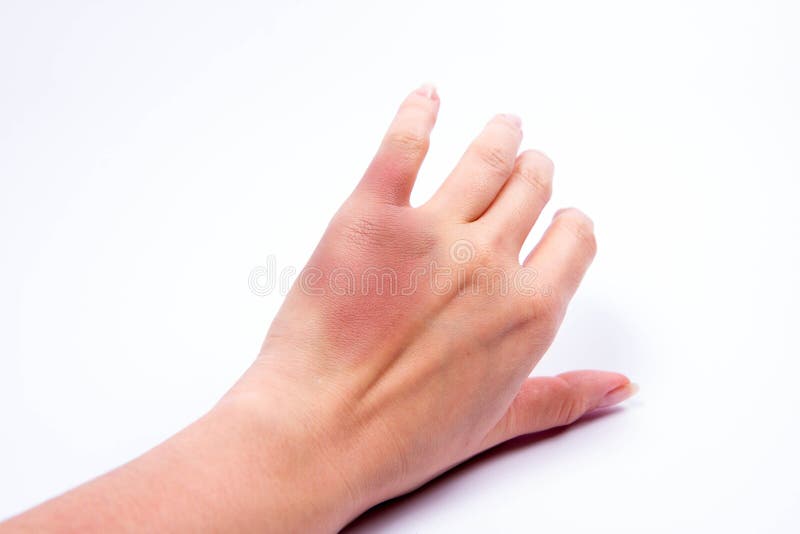 Bruised hand stock image. Image of woman, fight, bruise - 101632535