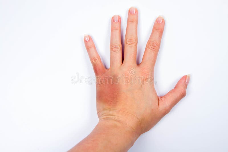 Bruised hand stock image. Image of hand, autopsy, beat - 101636371