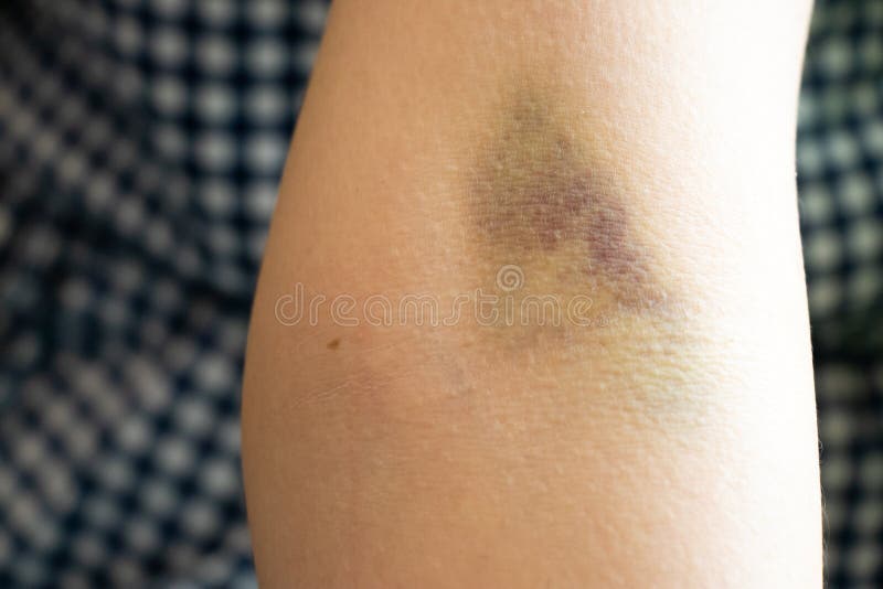 Bruise Injury on the Female Arm Background Stock Photo - Image of ...