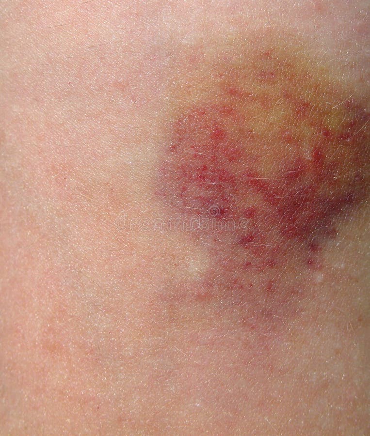 Bruised woman skin stock image. Image of disease, discoloration - 15409903