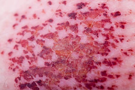 Bruised skin texture stock photo. Image of inflammation - 3145948