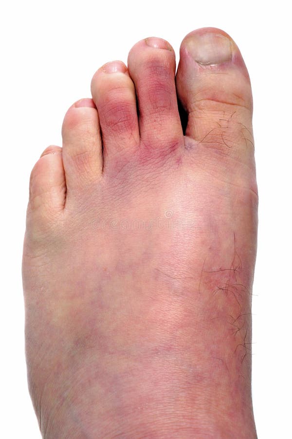 Bruised Swollen Foot Stock Photos - Free & Royalty-Free Stock Photos ...
