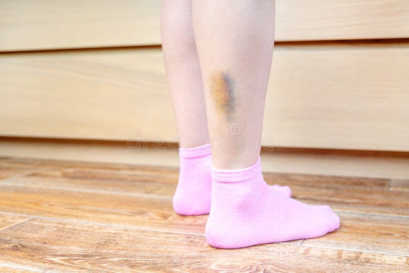 Bruised woman skin stock image. Image of disease, discoloration - 15409903