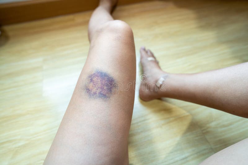 Bruises on Women S Legs, Accident Stock Photo - Image of human, concept ...
