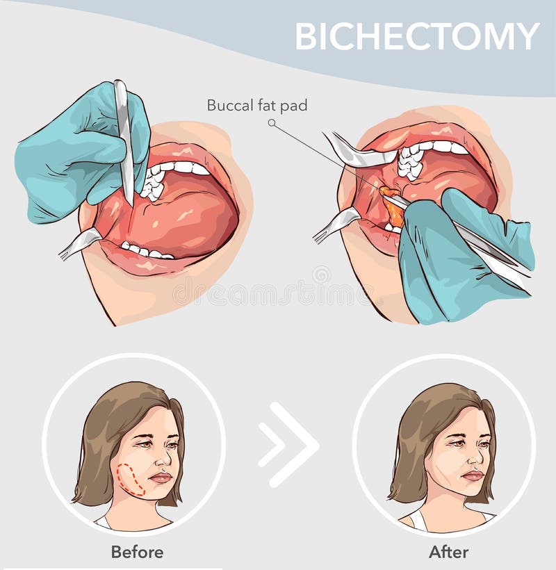 Buccal Fat Pad Removal before and after Vector Illustration Stock ...