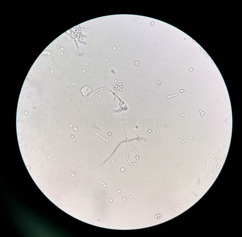 Budding Yeast Cells with Pseudohyphae in Urine Sample Stock Image ...