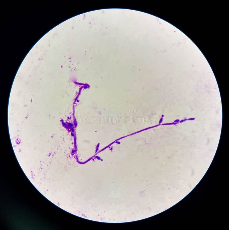 Budding Yeast Cells with Pseudohyphae in Urine Sample on Wright Gimsa ...