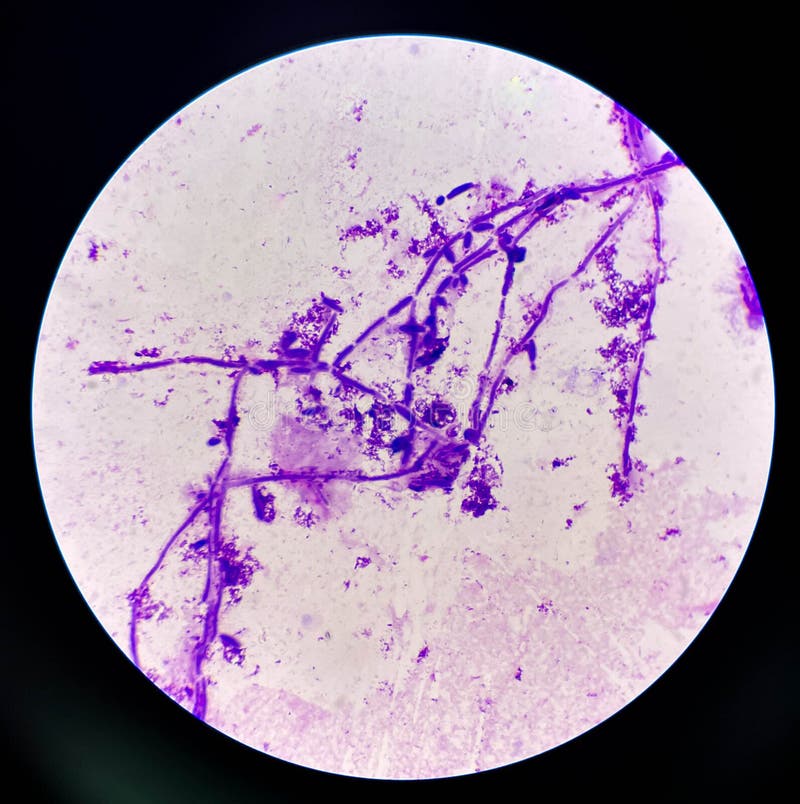Budding Yeast Cells with Pseudohyphae in Urine Sample on Wright Gimsa ...