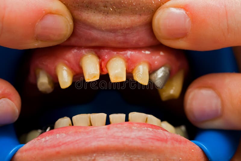 Buffed Teeth - Prosthetic Rehabilitation Stock Image - Image of close ...