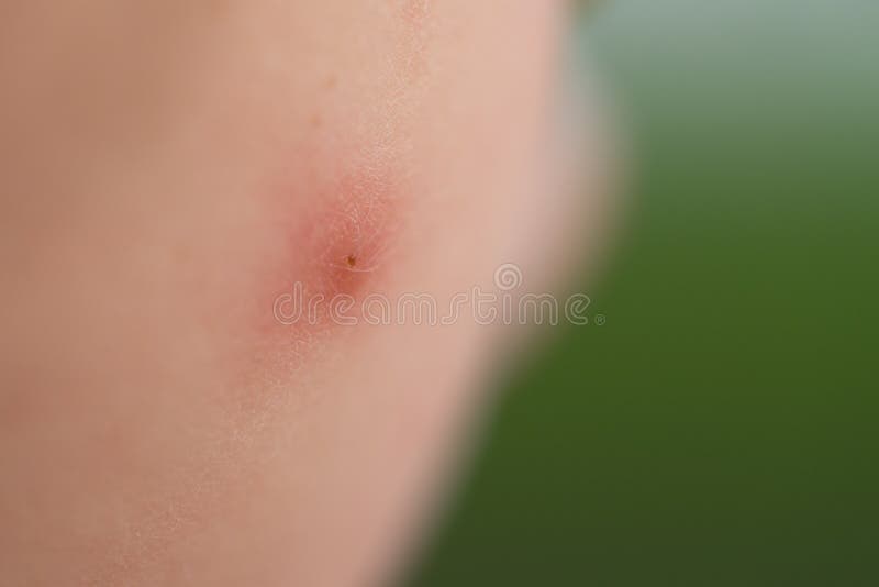 Bug Bite on Cheek stock image. Image of mosquito, irritate - 53596795