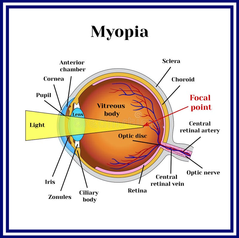 Bulbo Oculare Rifrangente Di Errori Ipermetropia Medicina Illustrazione ...