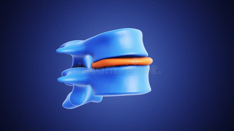Bulging Disc Disease Affecting the Spine Stock Illustration ...