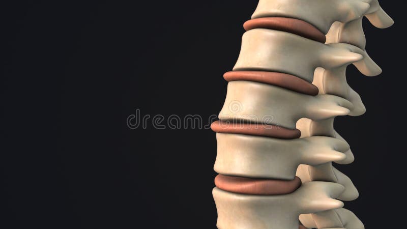 Bulging Disc in the Human Spine Stock Illustration - Illustration of ...