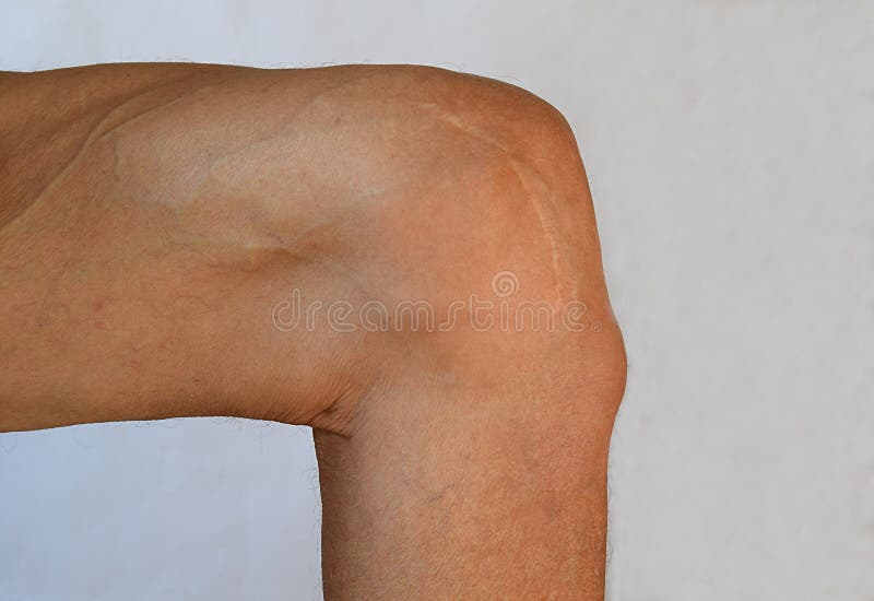 A Bump on the Leg Under the Knee Joint. White Background Stock Image ...