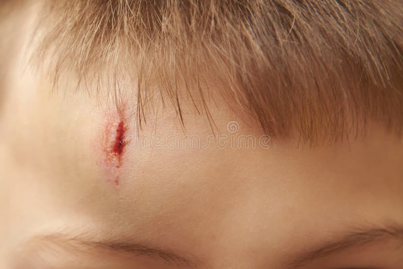 A Bump with an Open Wound on the Forehead with Pink Edges Stock Photo ...