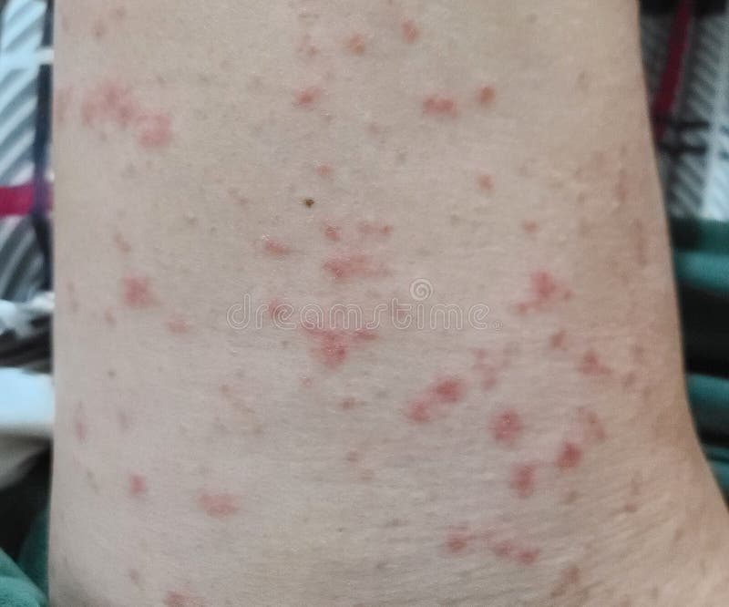 Bumpy Red Skin Rash stock image. Image of skin, bumps - 229170881