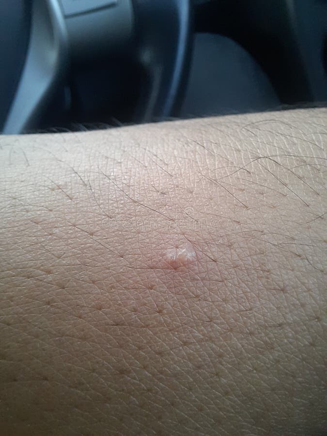 A Bumpy Rush on a Man& X27;s Hand Stock Photo - Image of rash, mans ...