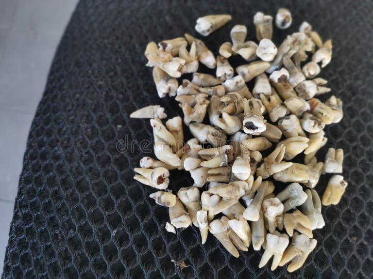 The Bundle of Unwanted Extracted Decay Human Teeth. Stock Image - Image ...