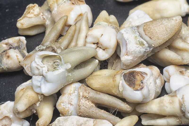 The Bundle of Unwanted Extracted Decay Human Teeth. Stock Image - Image ...