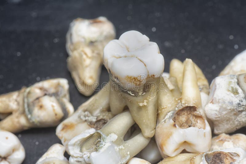 The Bundle of Unwanted Extracted Decay Human Teeth. Stock Photo - Image ...