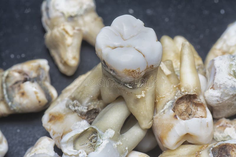The Bundle of Unwanted Extracted Decay Human Teeth. Stock Photo - Image ...
