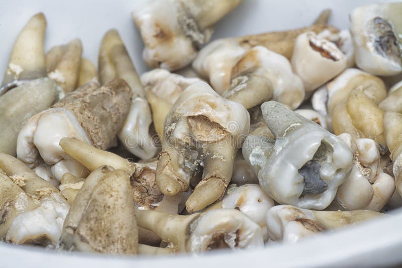 The Bundle of Unwanted Extracted Decay Human Teeth. Stock Image - Image ...