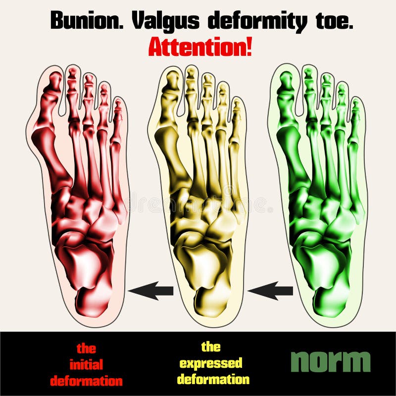 Bunion. Valgus Deformity Toe Stock Vector - Illustration of hallux ...