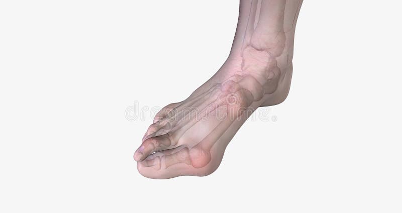 The Bunions and Overlapping Toes Stock Illustration - Illustration of ...