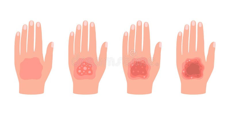 Burn Degree Diagram Medical Science Stock Illustration - Illustration ...