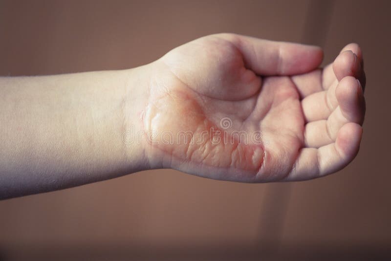 Burn injury stock image. Image of body, affliction, children - 64971987