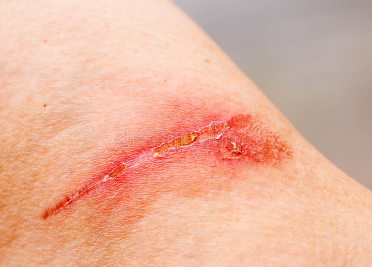 Burn Scar stock photo. Image of heal, sore, mark, blemish - 6112404
