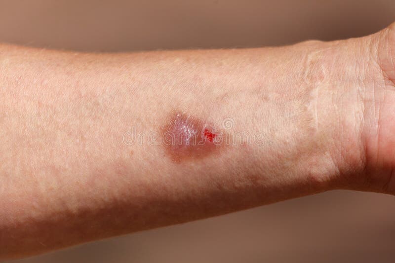 Burn Wound on Hand. Close-up Stock Photo - Image of medical, medicine ...