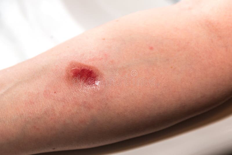 Burn wound - scalded arm stock image. Image of pain - 202976861