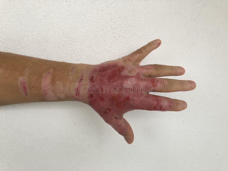 Burned hand stock photo. Image of hand, burnt, damaged - 101813624