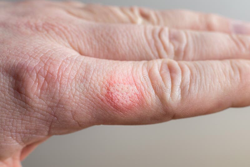 Burned Skin on a Finger of Caucasians Man Hand Stock Photo - Image of ...