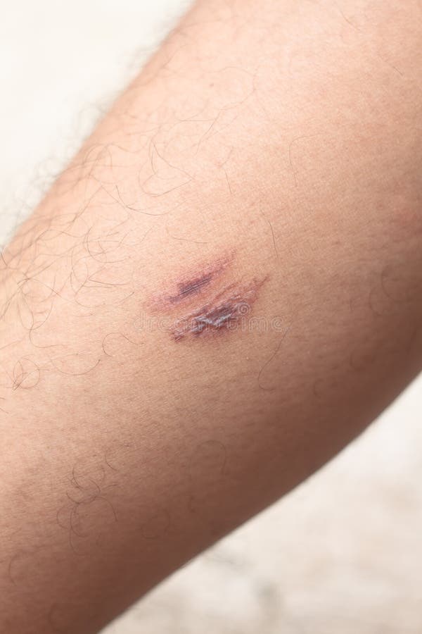 Before and after Second-degree Burns on Male Back Caused by Heat. Skin ...