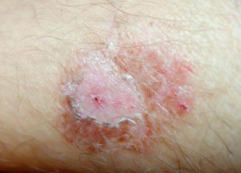 Burning skin stock photo. Image of accident, heal, hospital - 46167130