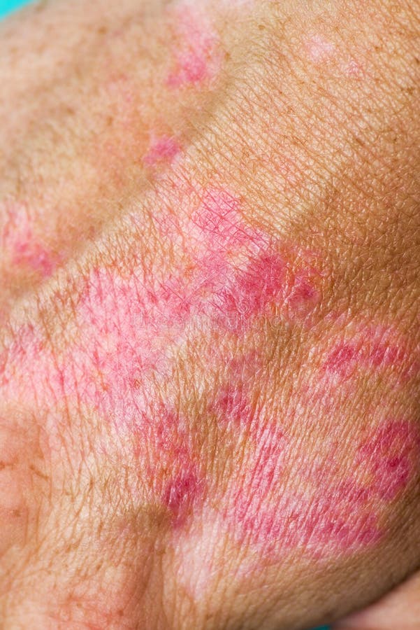 Burns of Hand, Wounds. Hand with Sunburn Stock Image - Image of flesh ...