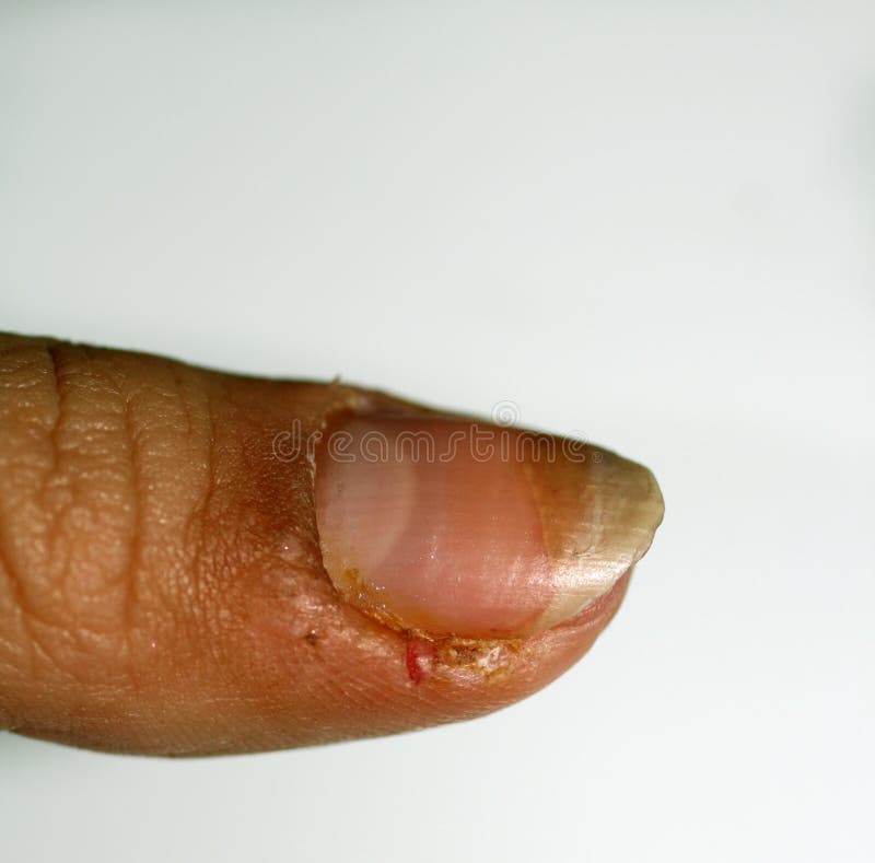 176 Finger Abscess Stock Photos - Free & Royalty-Free Stock Photos from ...