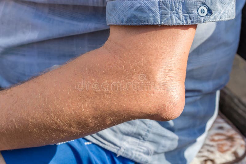 Bursa Inflamada En El Codo De Un Hombre Imagen de archivo - Imagen de ...