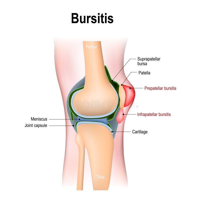 Knie Bursitis_Deep Infrapatellar Bursitis Vector Illustratie - Illustration of vezel, dijbeen ...