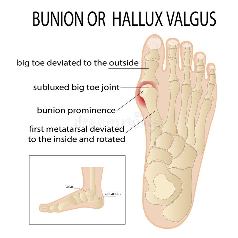 Bursitis on the Sides of the Foot. the Bone and Skin on the Sides of ...