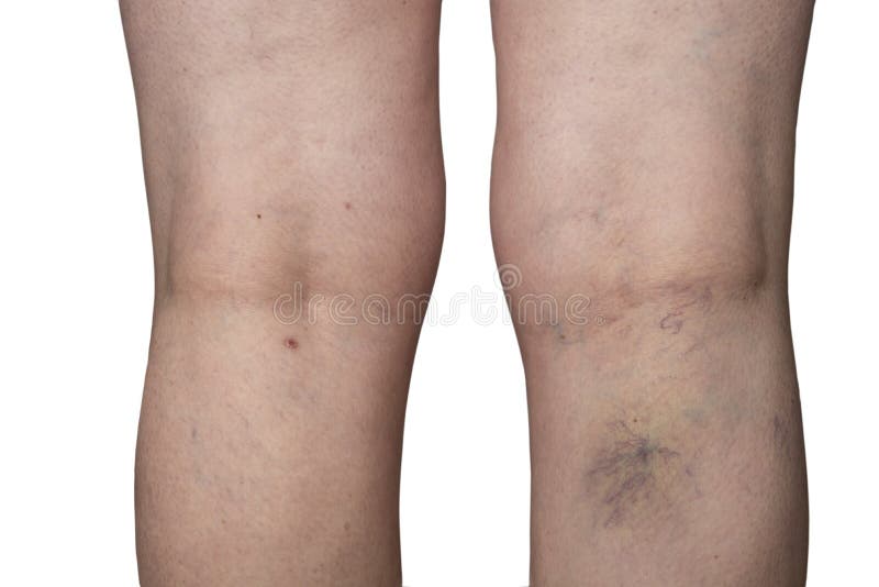 Ruptured Vein Stock Photos - Free & Royalty-Free Stock Photos from ...